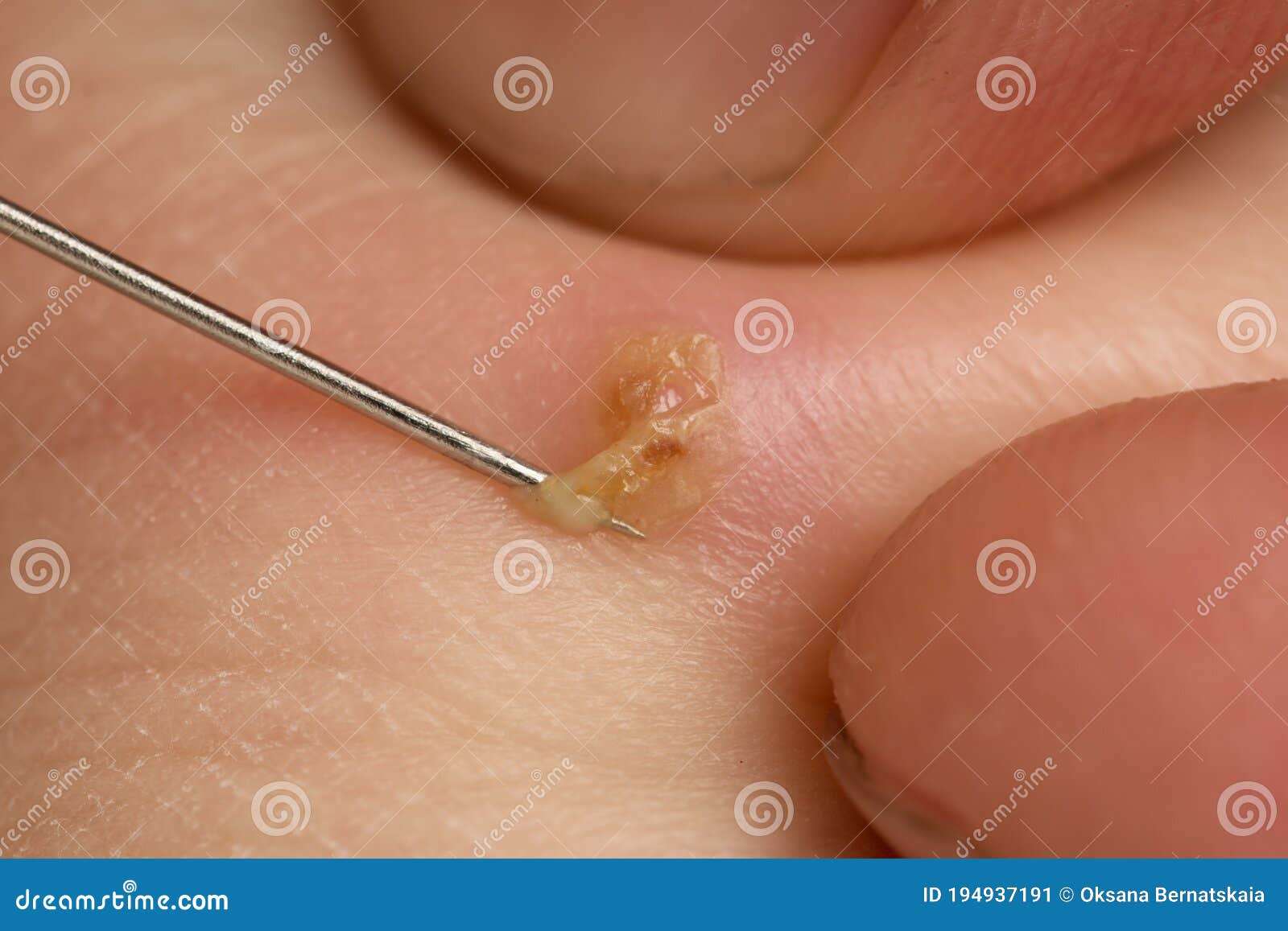 Abscess with Pus on the Skin Stock Image - Image of abscess, hygiene ...