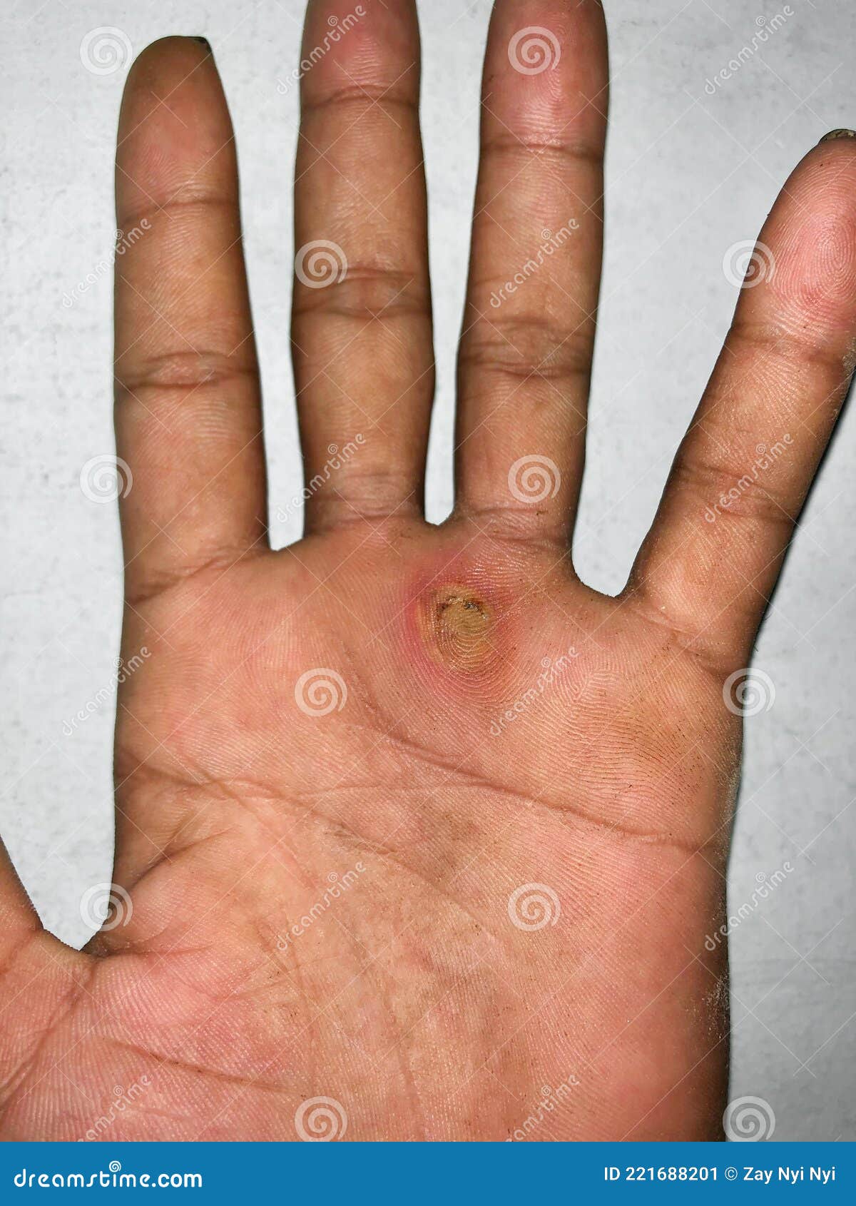 Abscess With Surrounding Cellulitis Or Staphylococcal Streptococcal