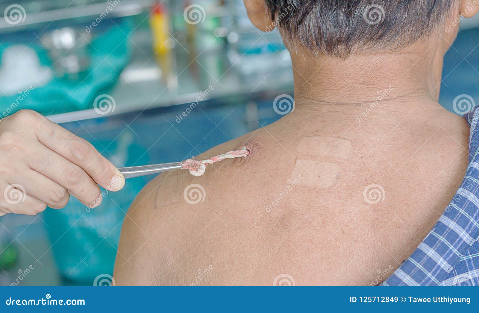 Abscess wound close-up stock image. Image of physical - 125712849