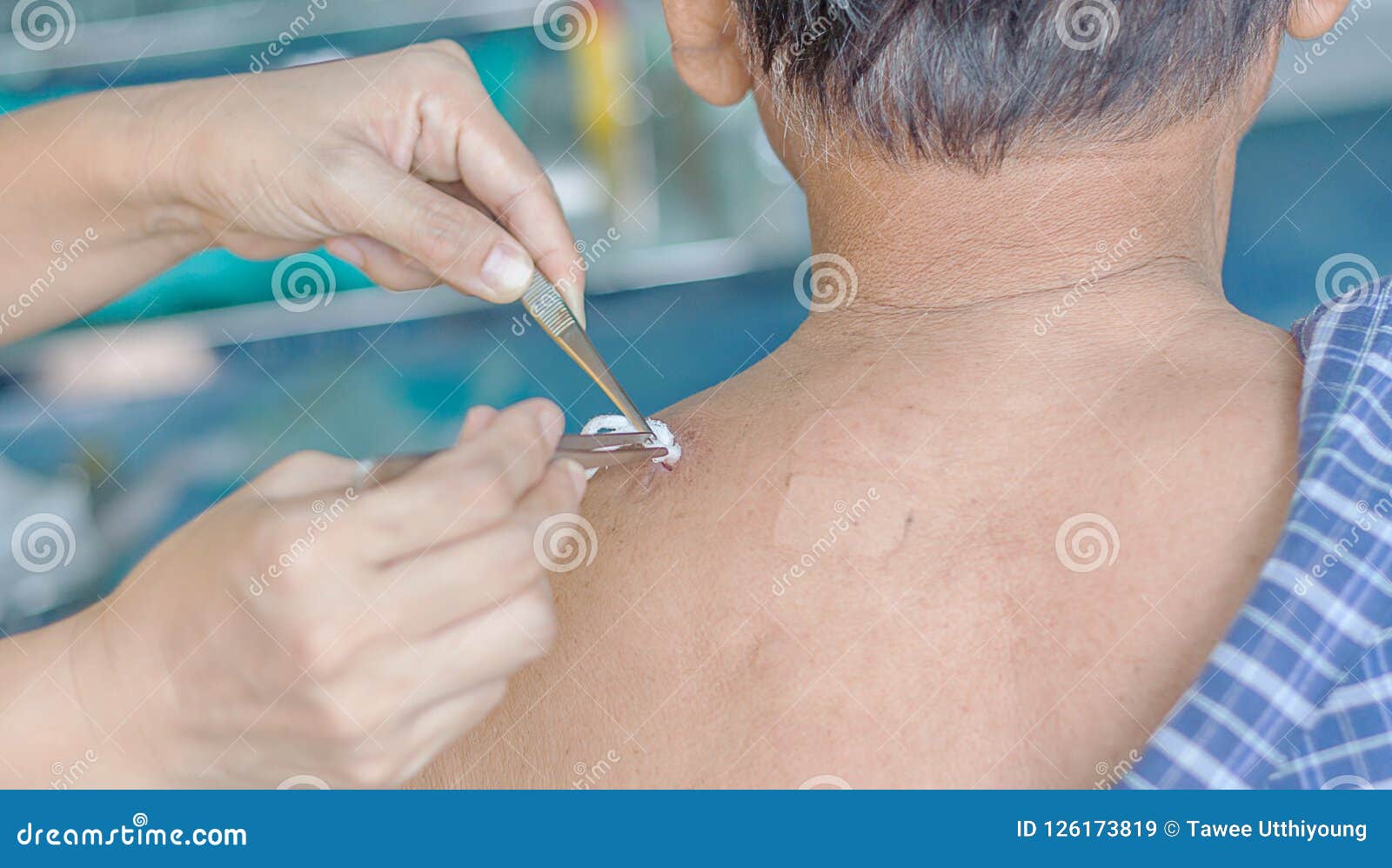 Abscess wound close-up stock image. Image of inflammation - 126173819