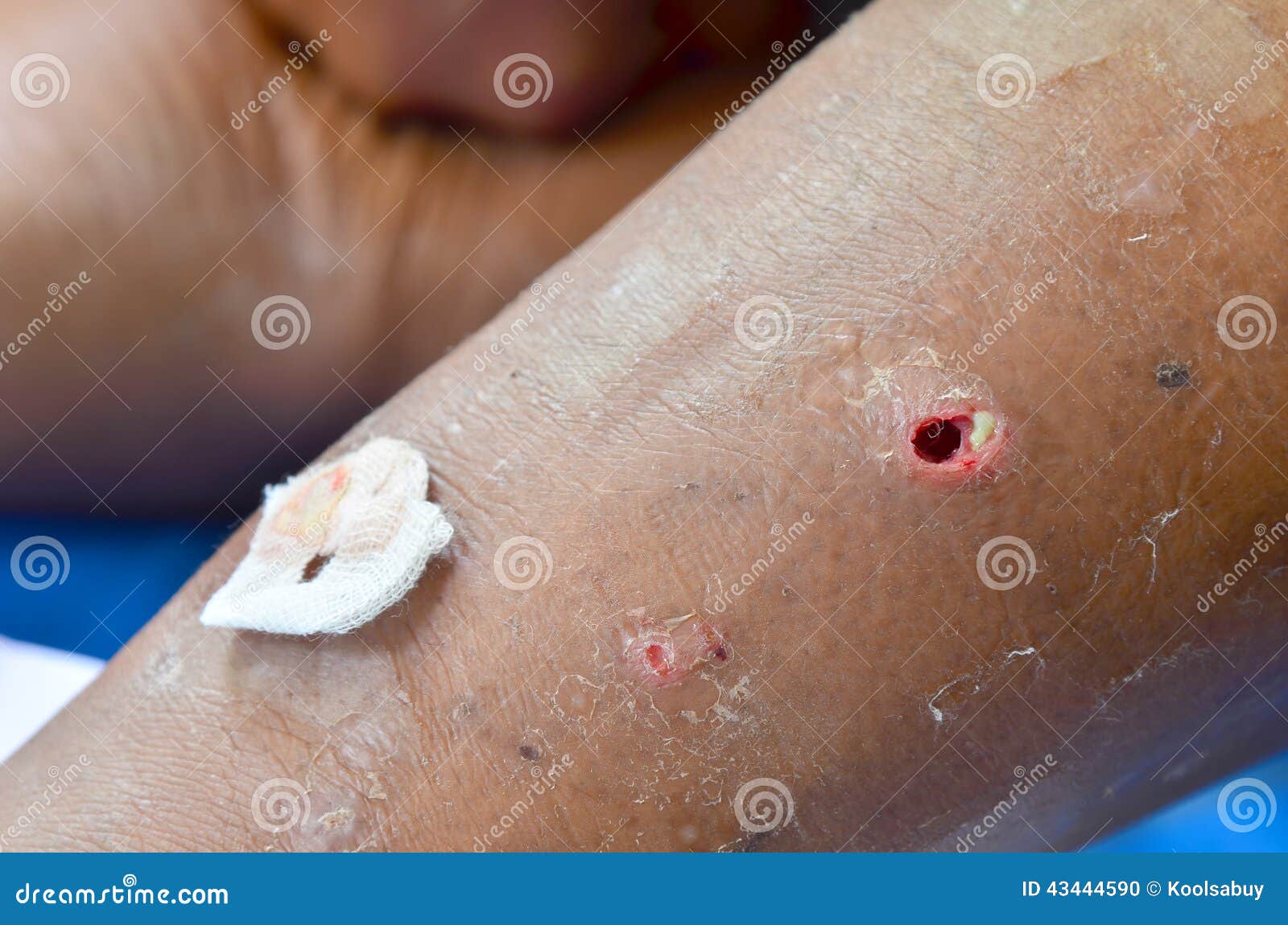 Abscess wound. stock photo. Image of reconstruction, blood - 43444590