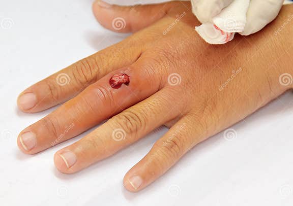 Abscesses Form after Bacteria Stock Image - Image of form, illness ...