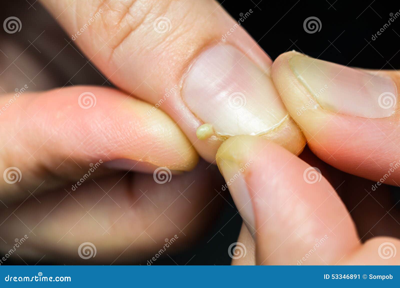 Abscesses Form after Bacteria Stock Image - Image of gland, drainage ...