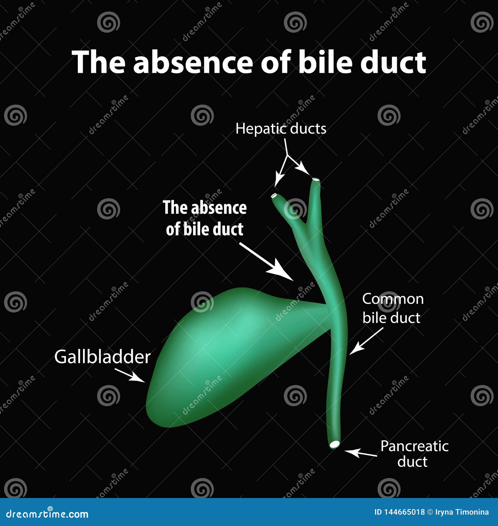 The Absence of Bile Duct. Pathology of the Gallbladder. Cholecystitis ...