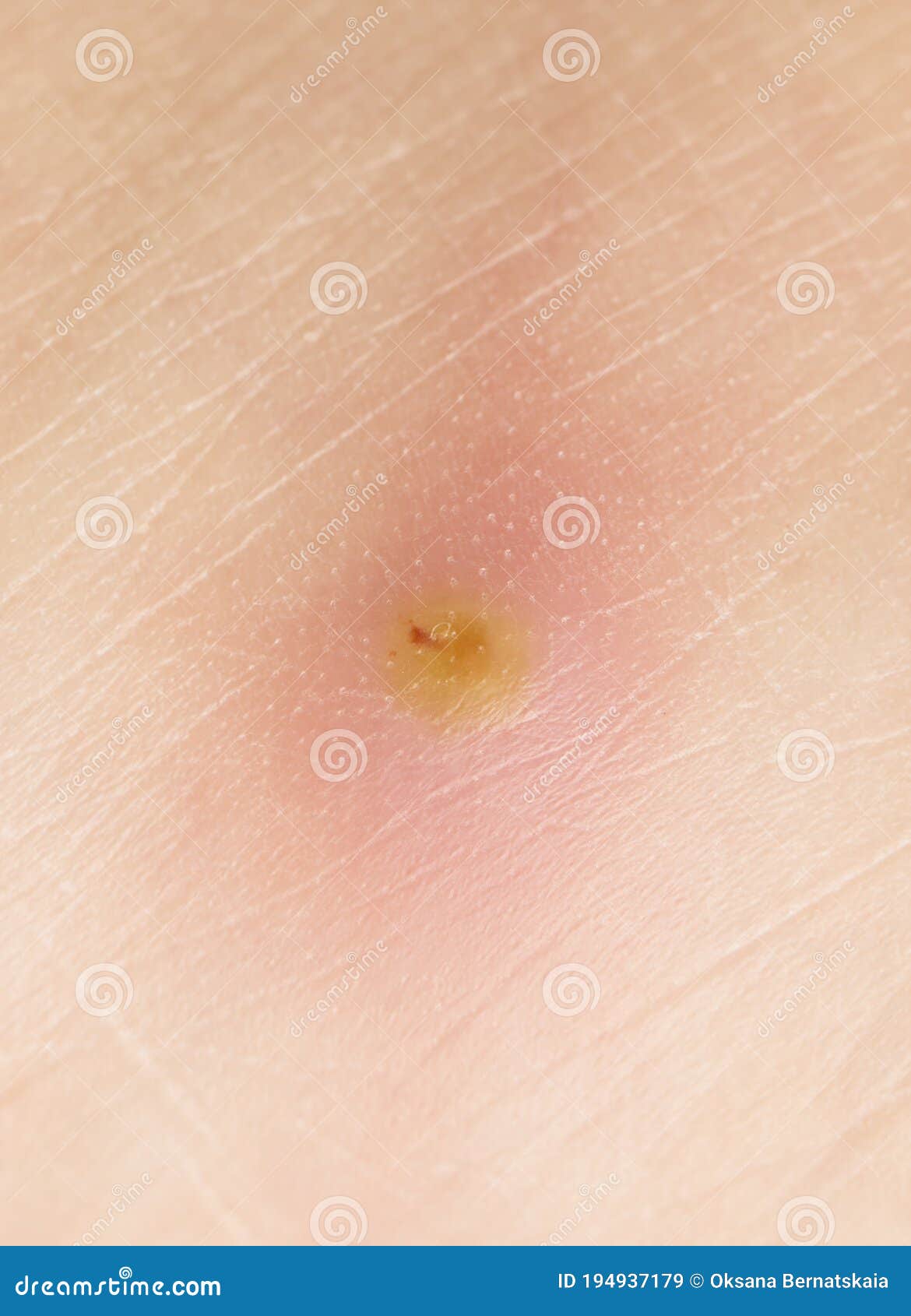 Abszess Mit Eiter Auf Der Haut Stockbild - Bild von mann, hygiene ...