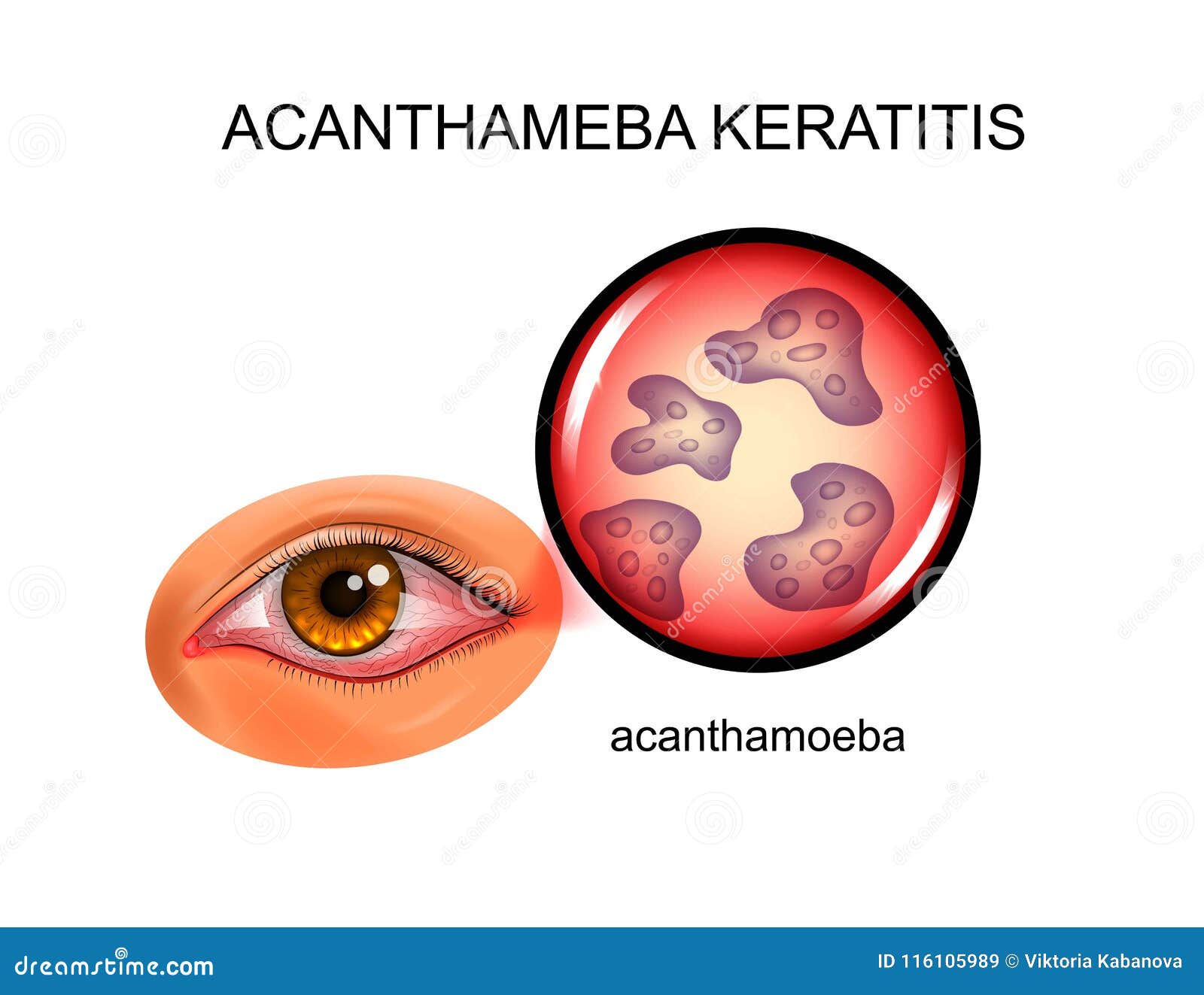 Inflammation Of The Fundus, Retinal Detachment Cartoon Vector ...