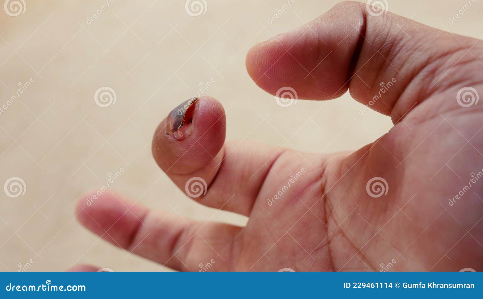 The Accident Left the Fingers. Stock Photo - Image of erosion, hematoma ...