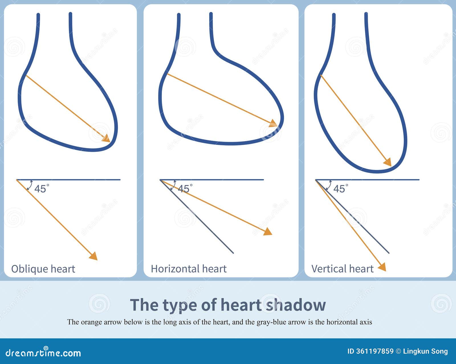 The type of heart shadow stock image. Image of axis - 361197859