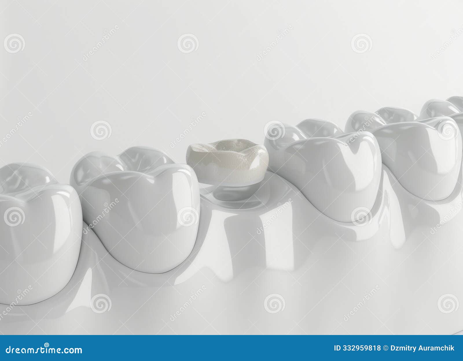 An Accurate 3D Animation of the Placement of an Inlay Ceramic Crown ...