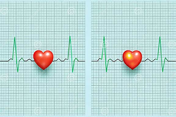 Accurate ECG Lead Placement Visual Guide for Precise Positioning and ...