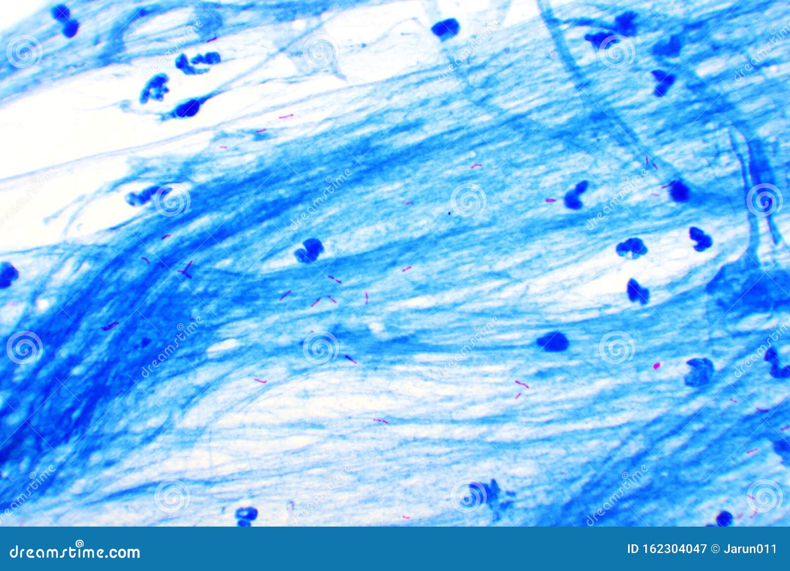 Acid-fast Bacilli Positive in Sputum Smear Stock Image - Image of ...