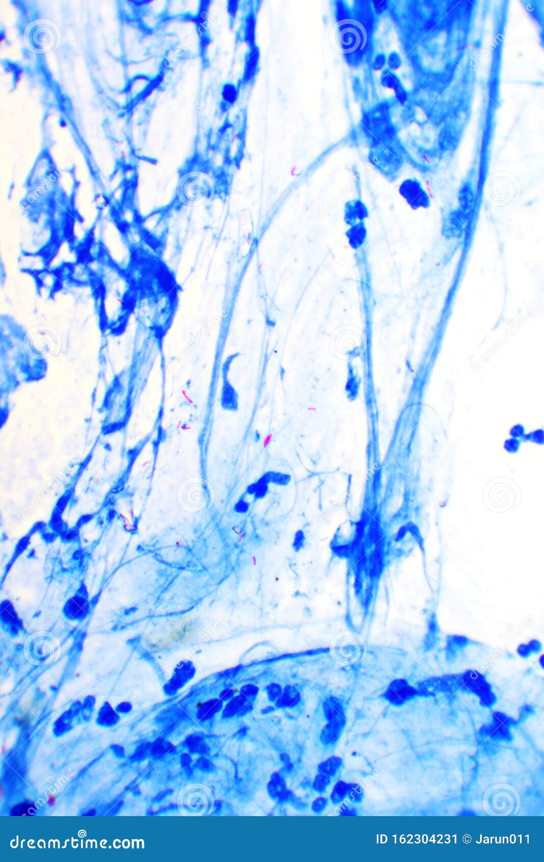 Acid-fast Bacilli Positive In Sputum Smear Royalty-Free Stock Photo ...