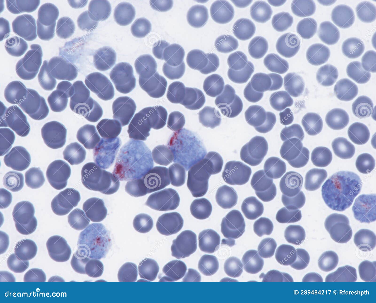 Acid Phosphatase in a Case of T Lymphoblastic Leukemia Stock ...