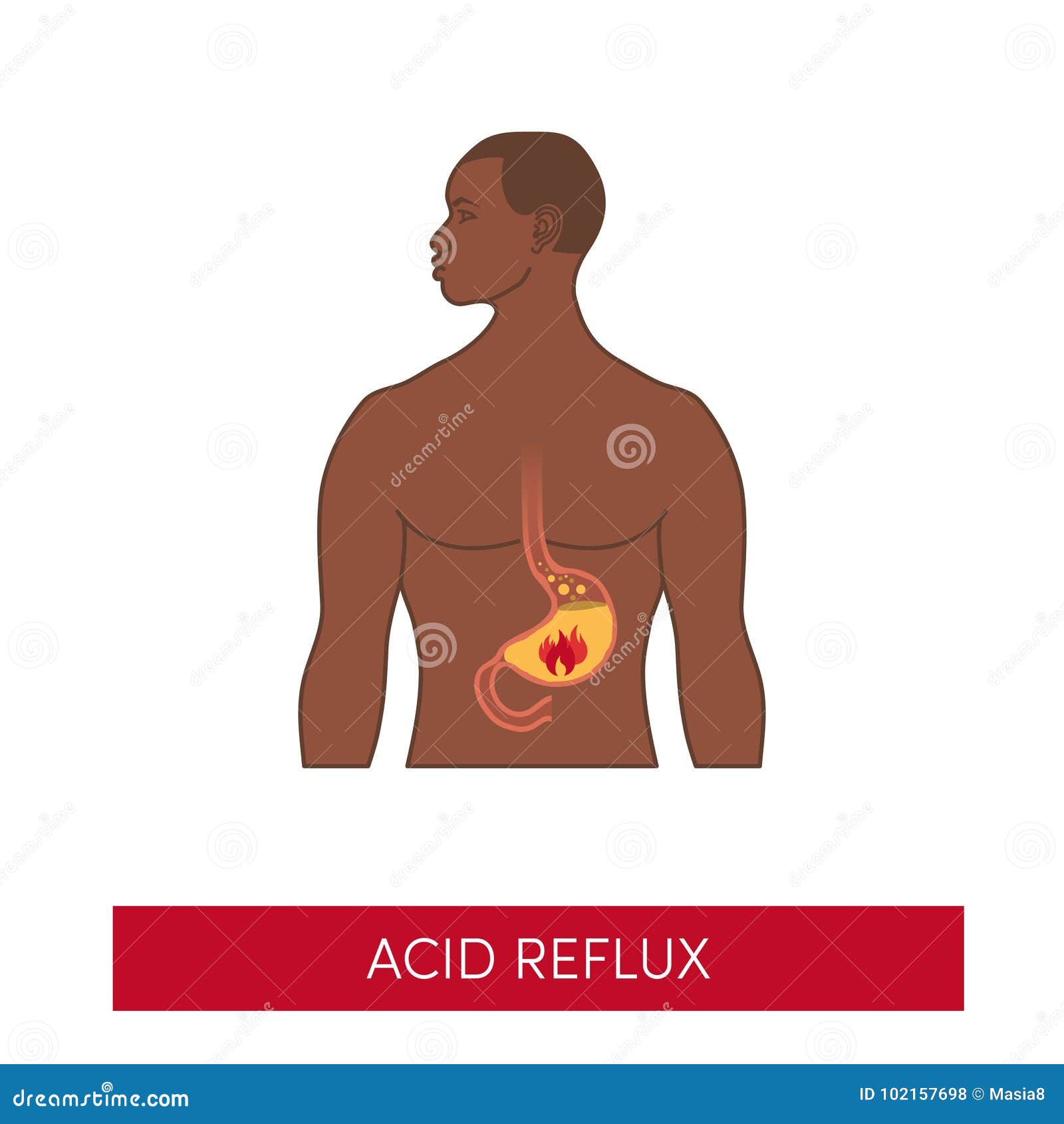 Acid reflux disease stock illustration. Illustration of cartoon - 102157698