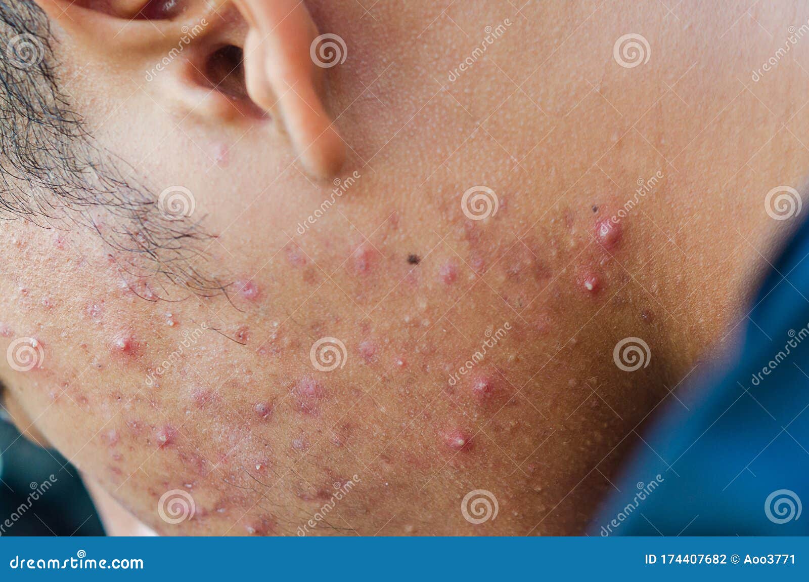 Acné inflamatorio foto de archivo. Imagen de cara, adolescencia - 174407682