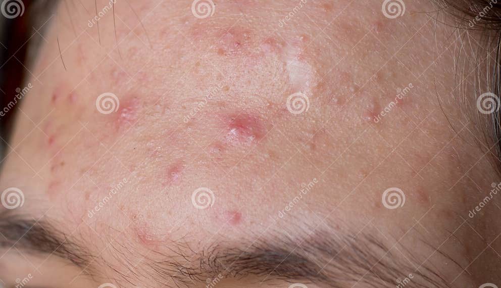 Acne stock photo. Image of close, facial, cosmetics, looking - 22039842
