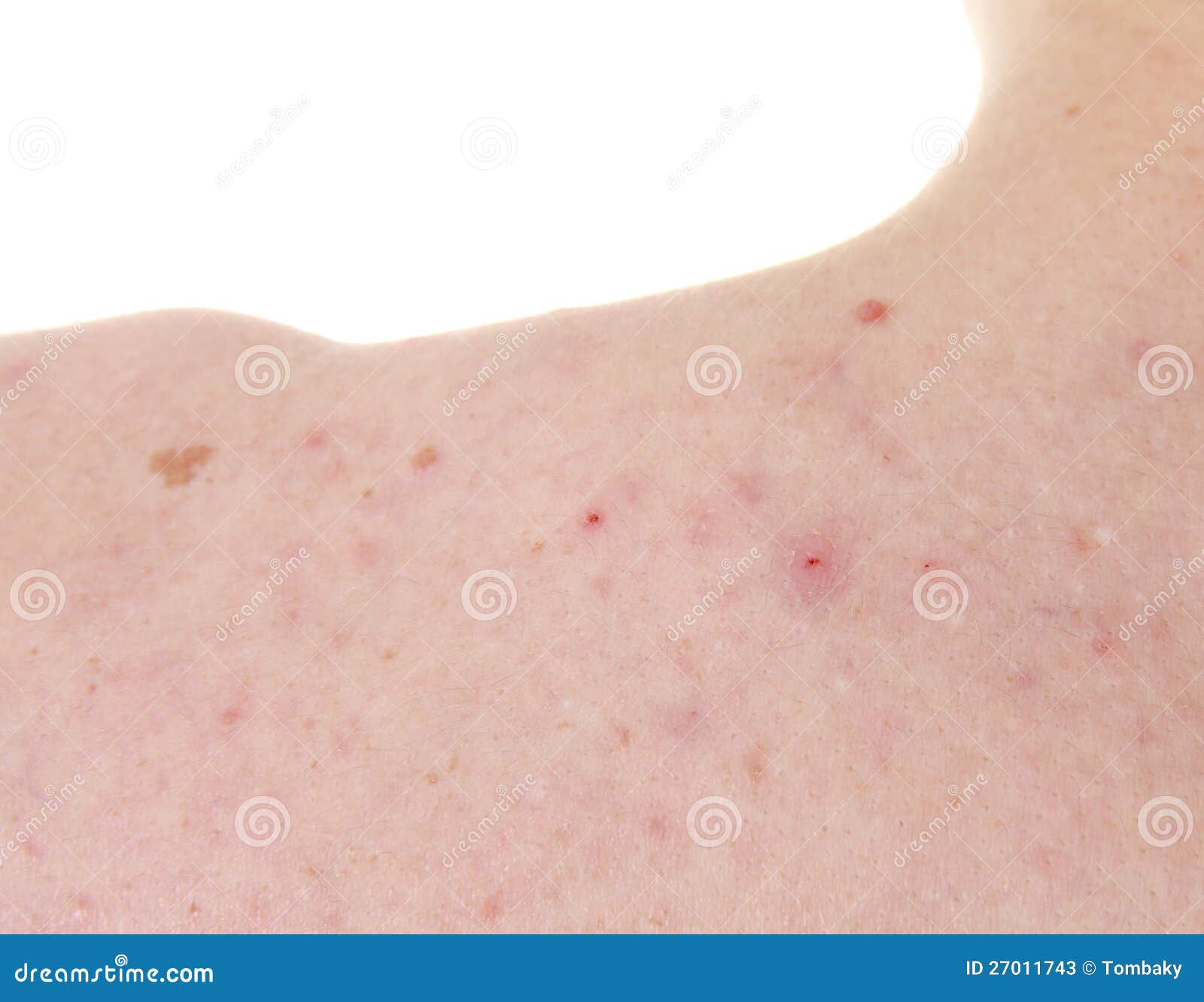 Acne stock image. Image of blemishes, care, person, puberty - 27011743
