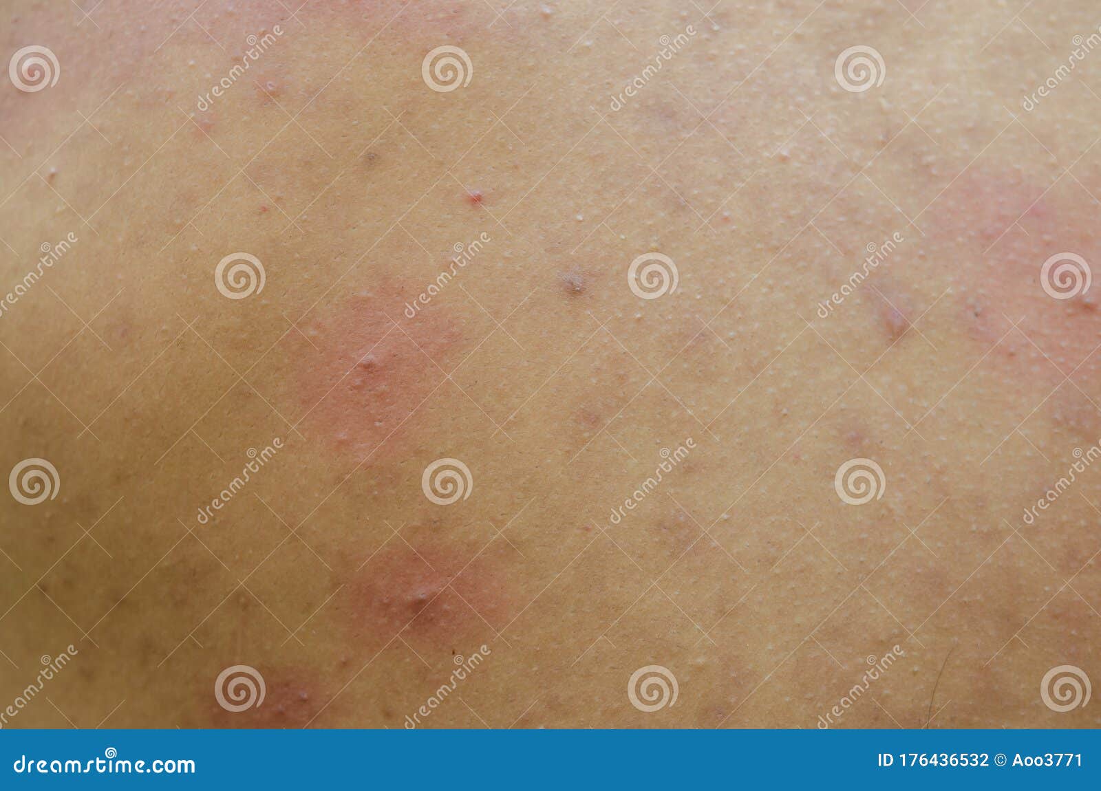 Acne on the back stock photo. Image of pimple, skincare - 176436532