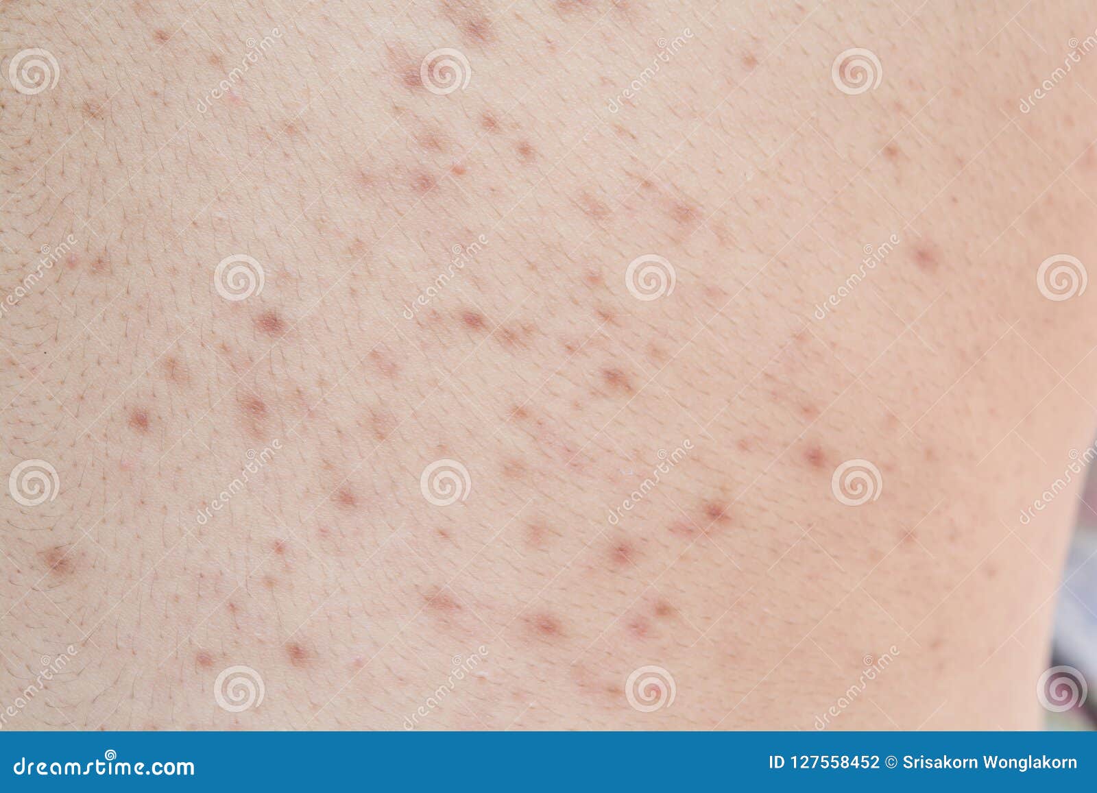 Acne on the back stock photo. Image of disease, dermatology - 127558452