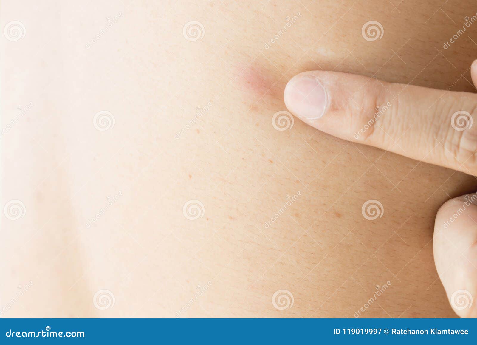 Acne on the Back of the Men. Stock Image - Image of beauty, medical ...