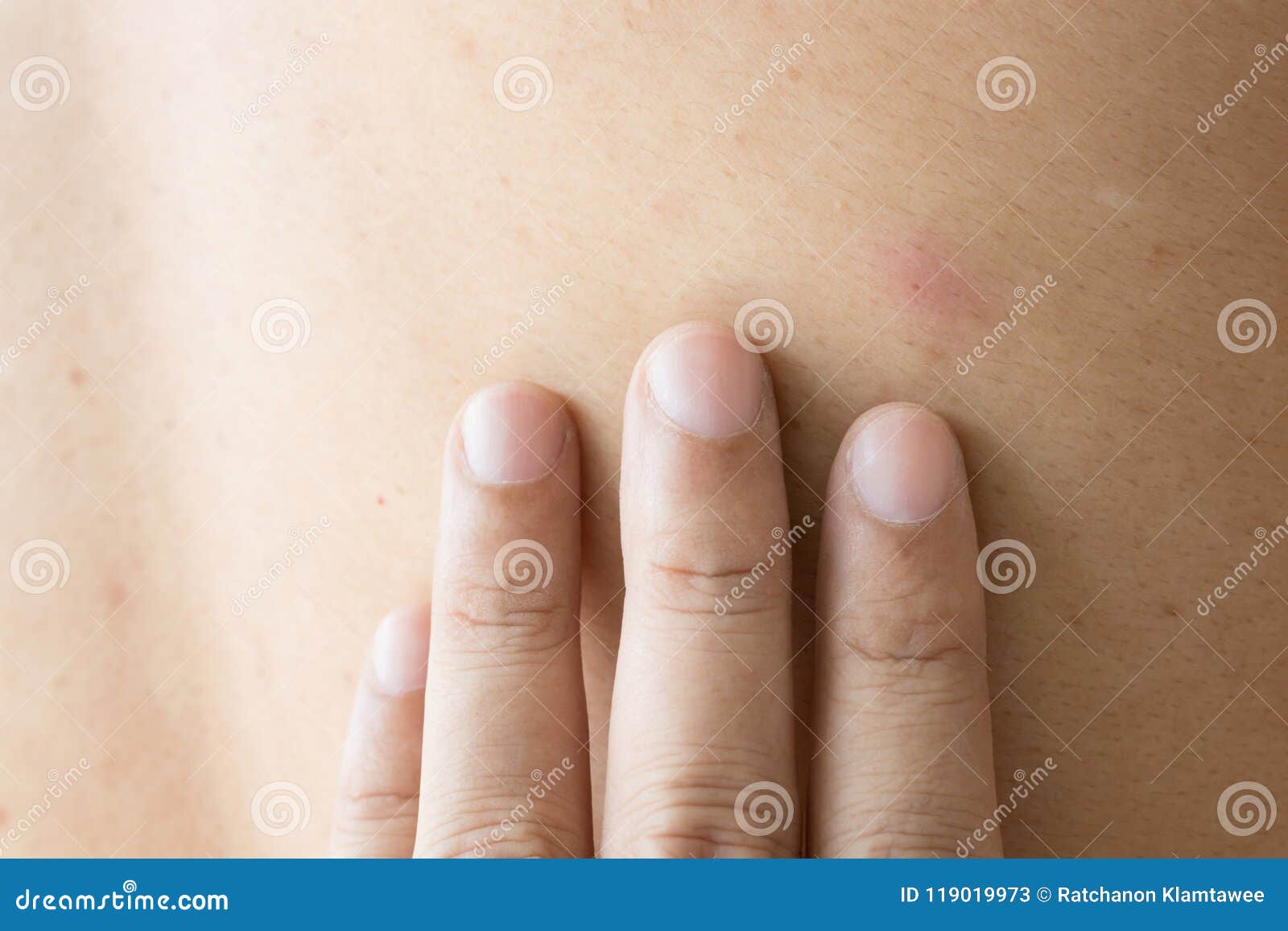 Acne on the Back of the Men. Stock Image - Image of disease, beauty ...