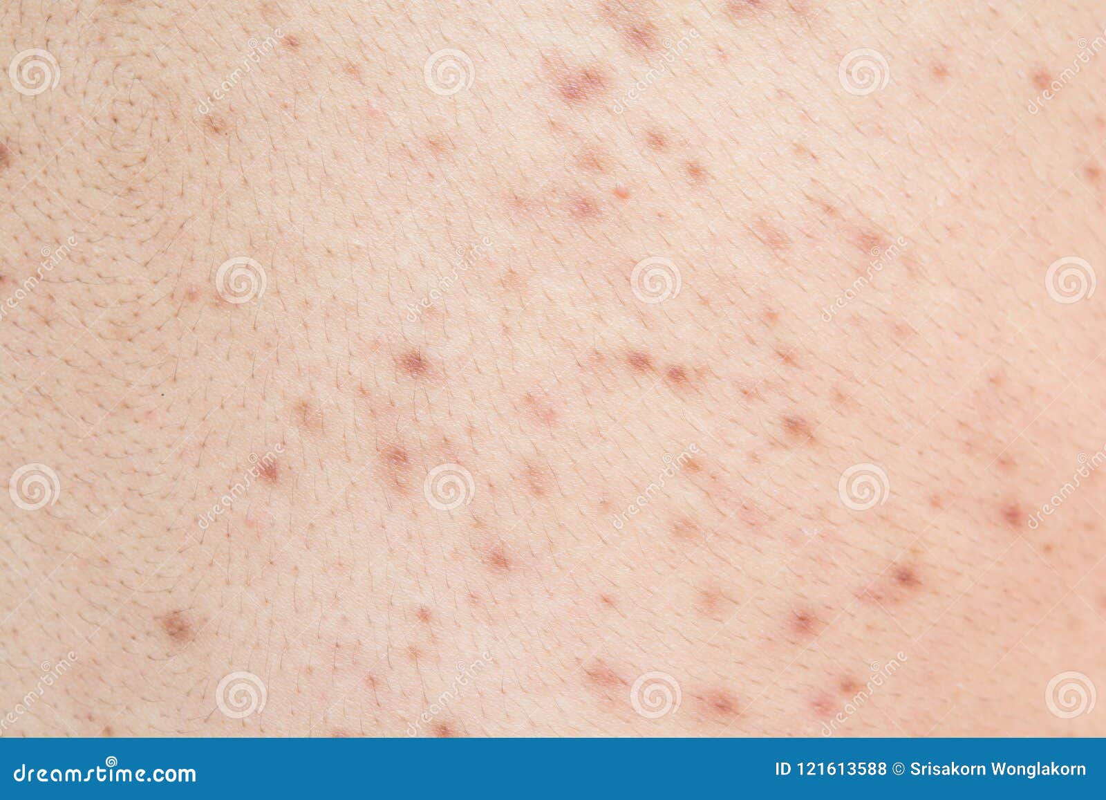 Acne on the back stock photo. Image of medical, concept - 121613588