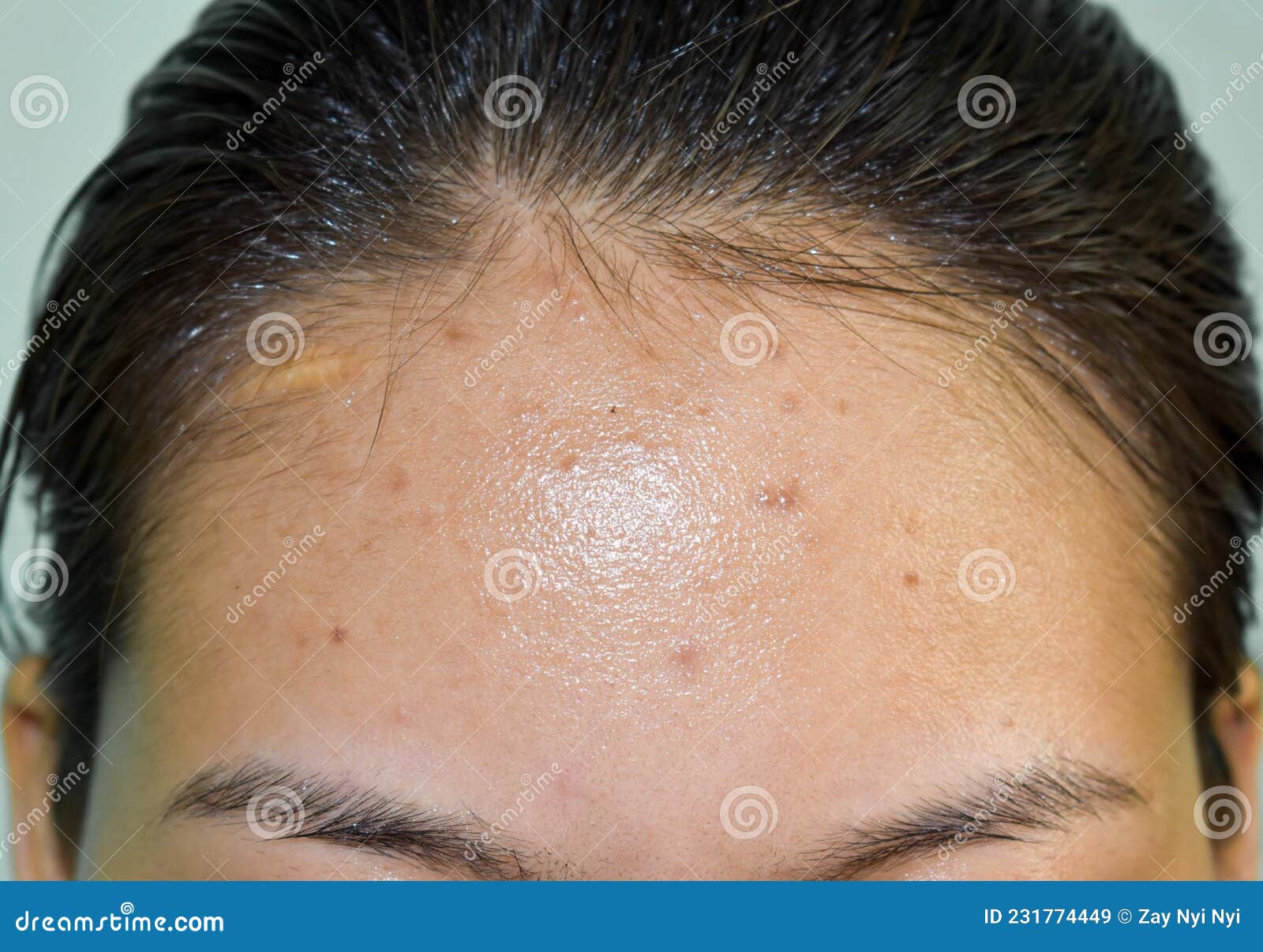 Acne , Black Spots and Scars on Forehead Stock Image - Image of ... Acne , Black Spots and Scars on Forehead Stock Image - Image of ...