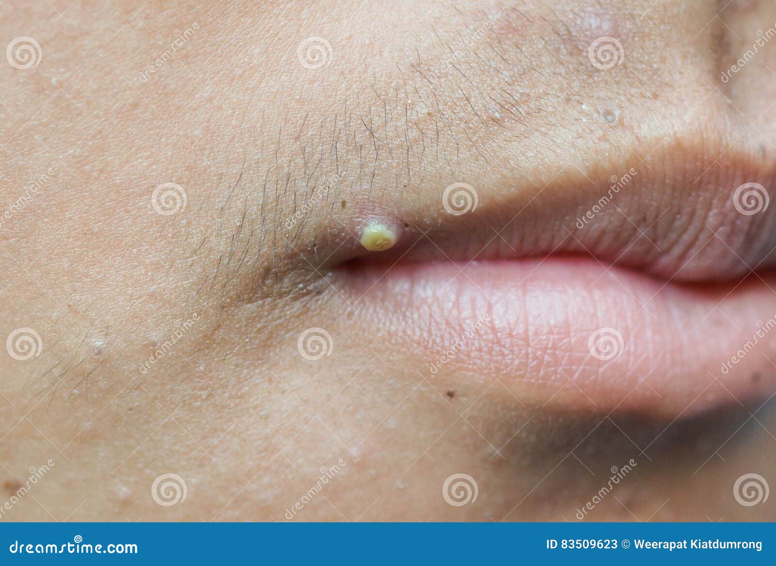 Acne on face stock image. Image of nodular, infection - 83509623