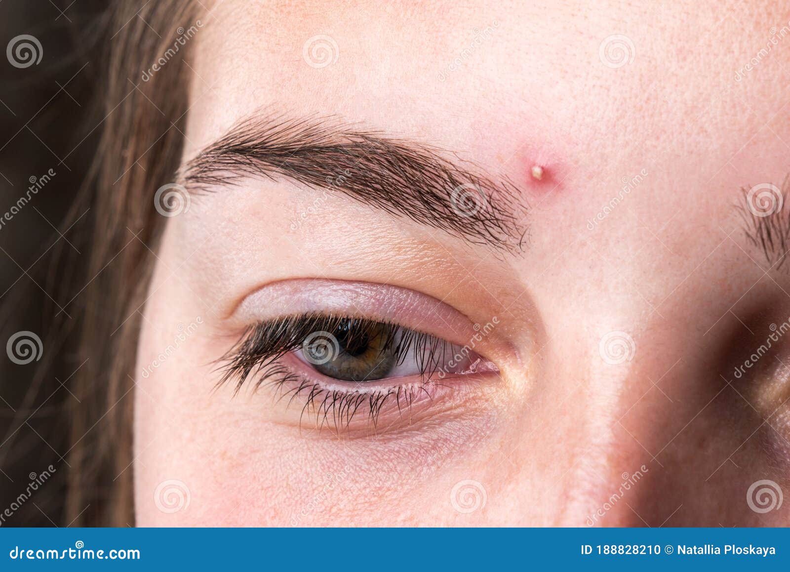 Acne on Female Forehead. Problem Skin Stock Photo - Image of teen ...