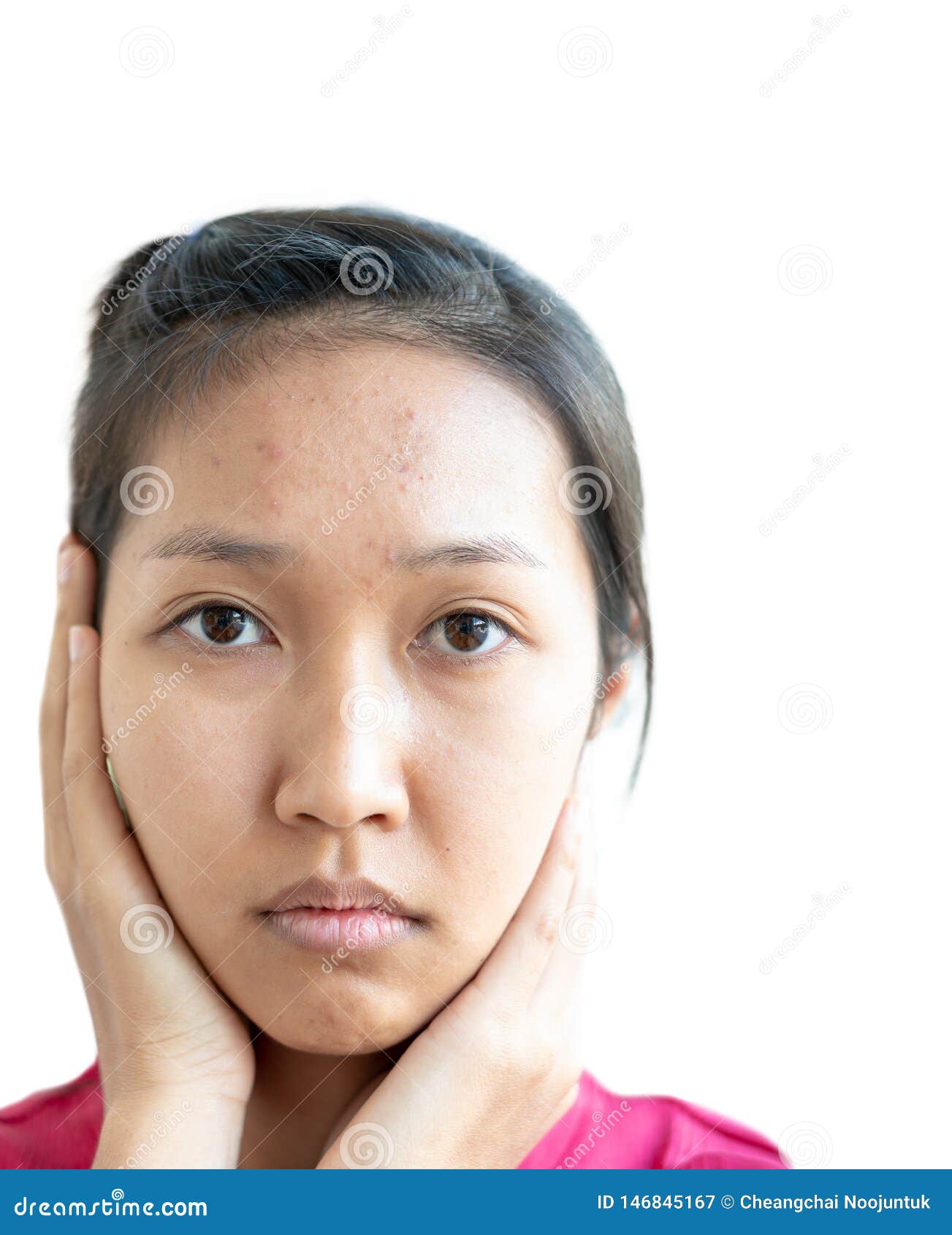 Acne on the Forehead of a Woman Stock Image - Image of healthy, acne ...