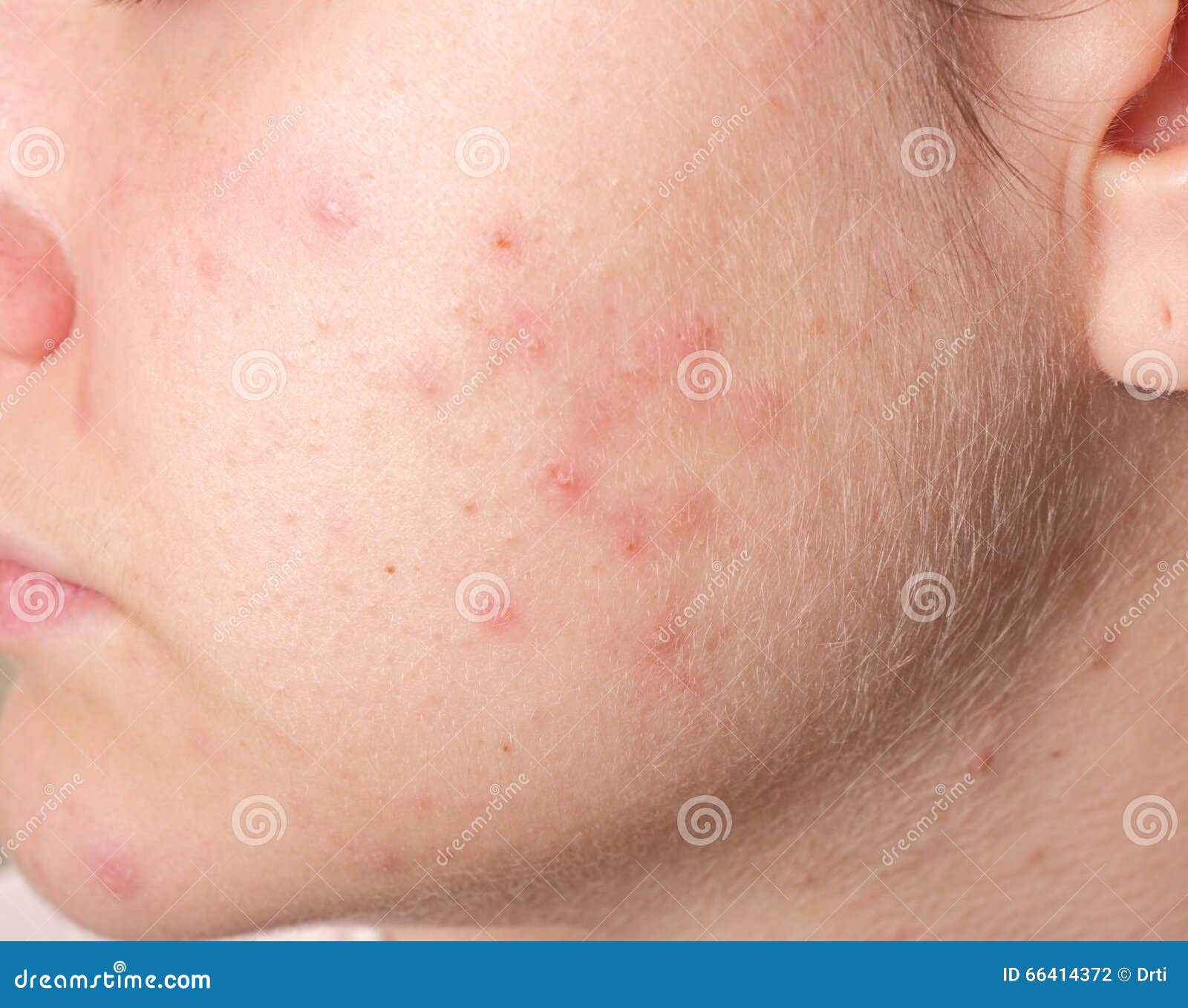 Acne on the girl s face stock photo. Image of adolescence - 66414372