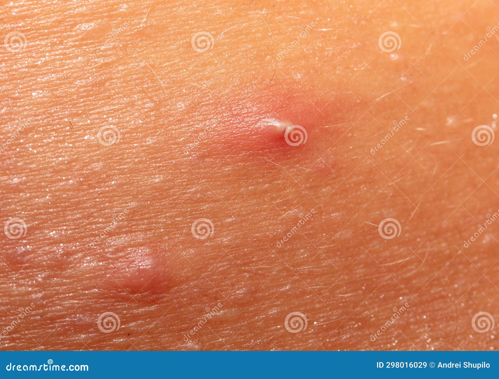 Acne on human skin. Macro stock image. Image of human - 298016029