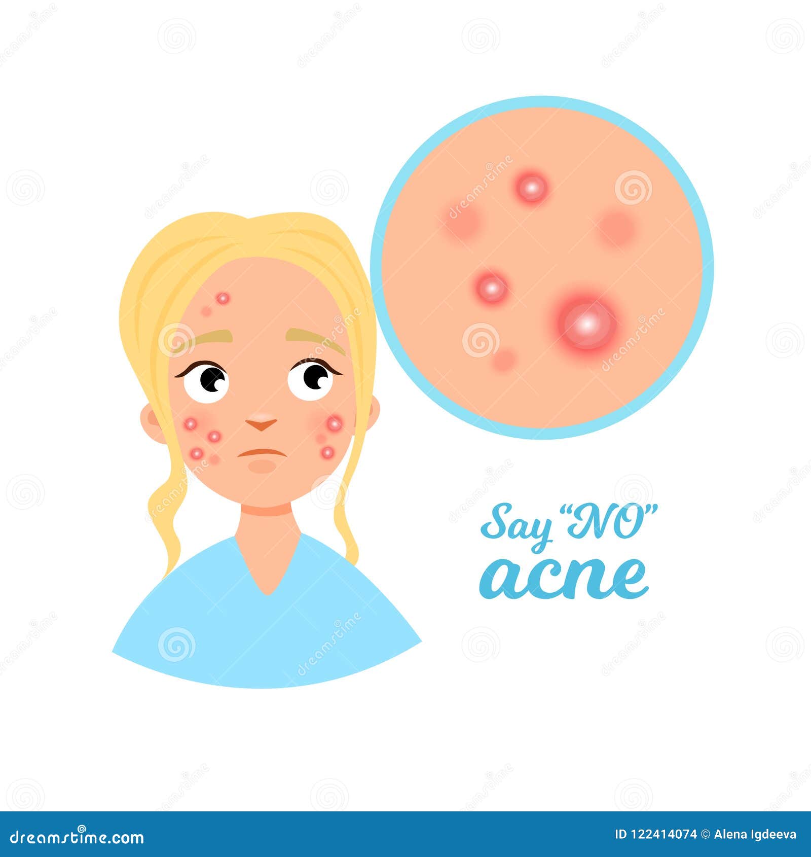 Acne Infographics Stock Vector Illustration Of Pimple 122414074
