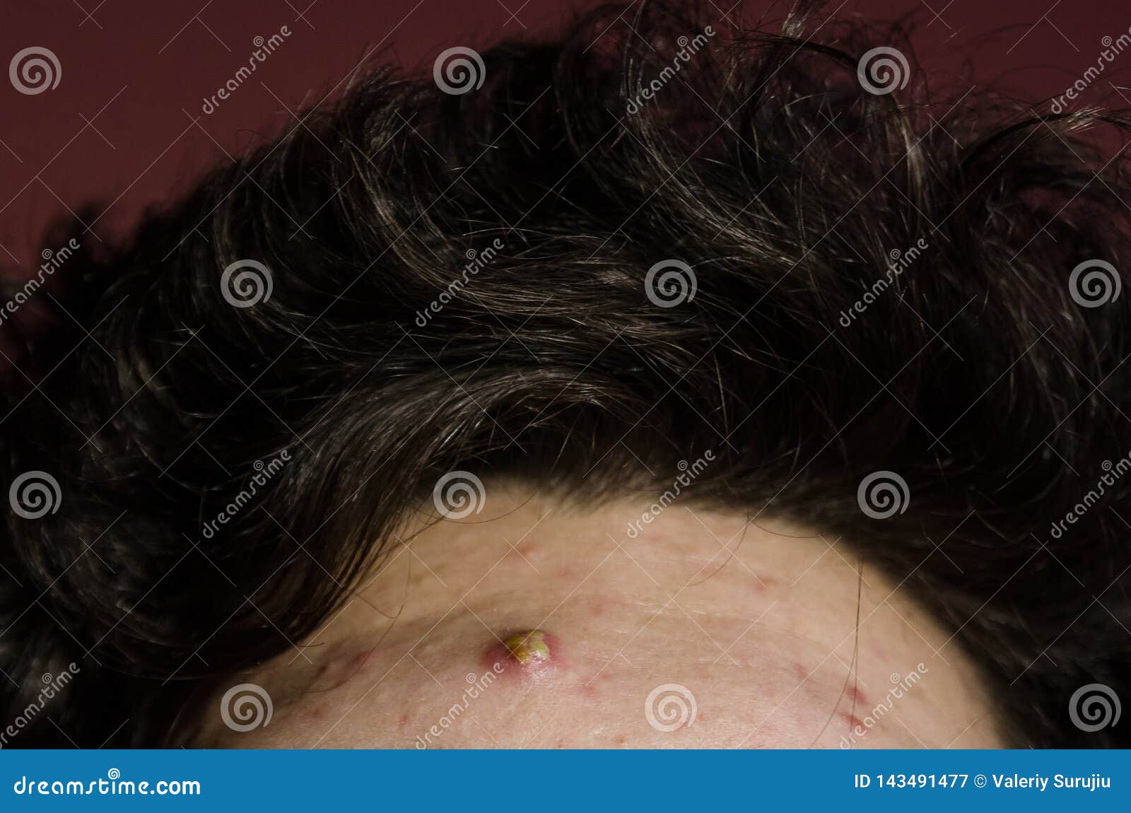 An acne on man`s forehead stock image. Image of body - 143491477