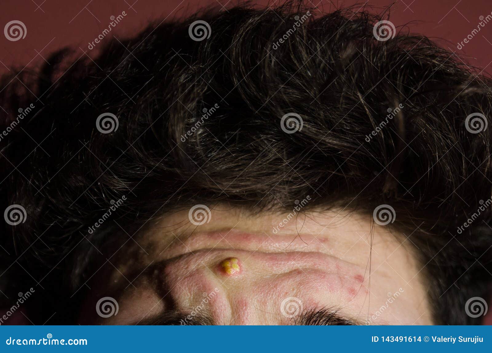 An acne on man`s forehead stock photo. Image of beauty - 143491614