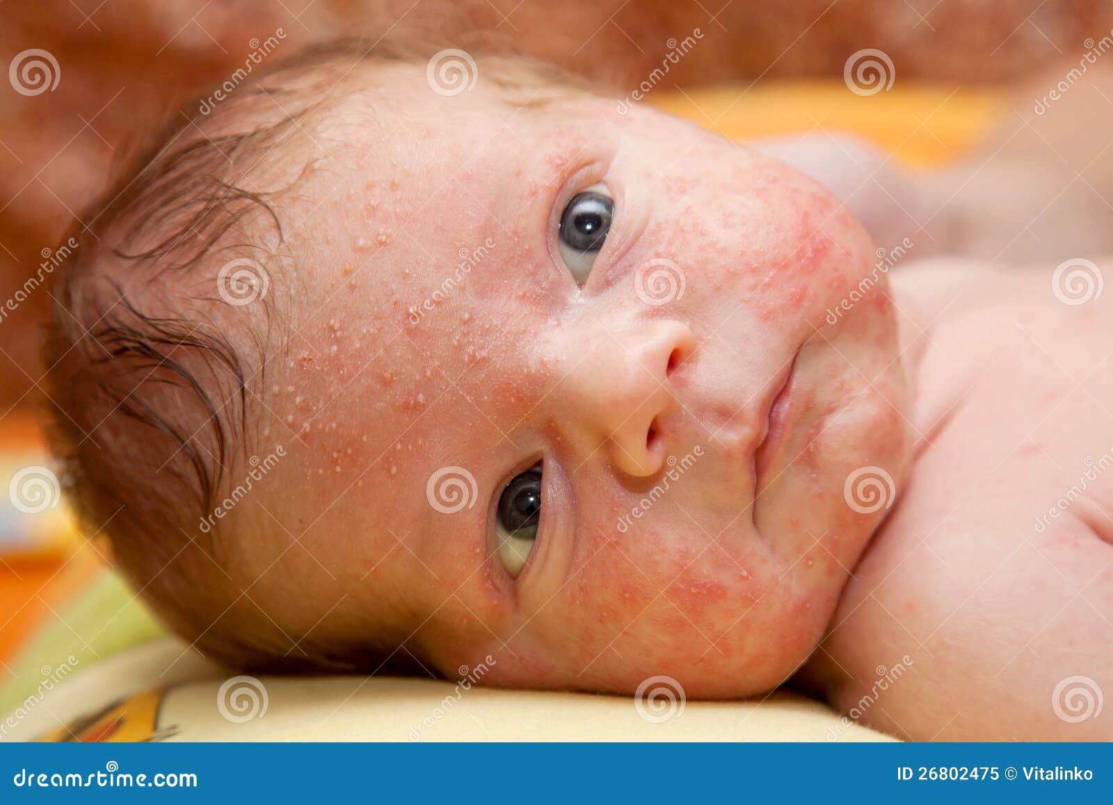 Acne neonatorum stock image. Image of glands, child, immaturity - 26802475