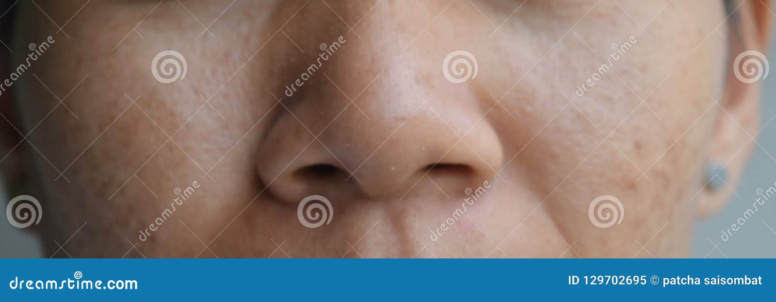 Acne On The Nose And Black Spots Caused By Melasma. Royalty-Free Stock ...