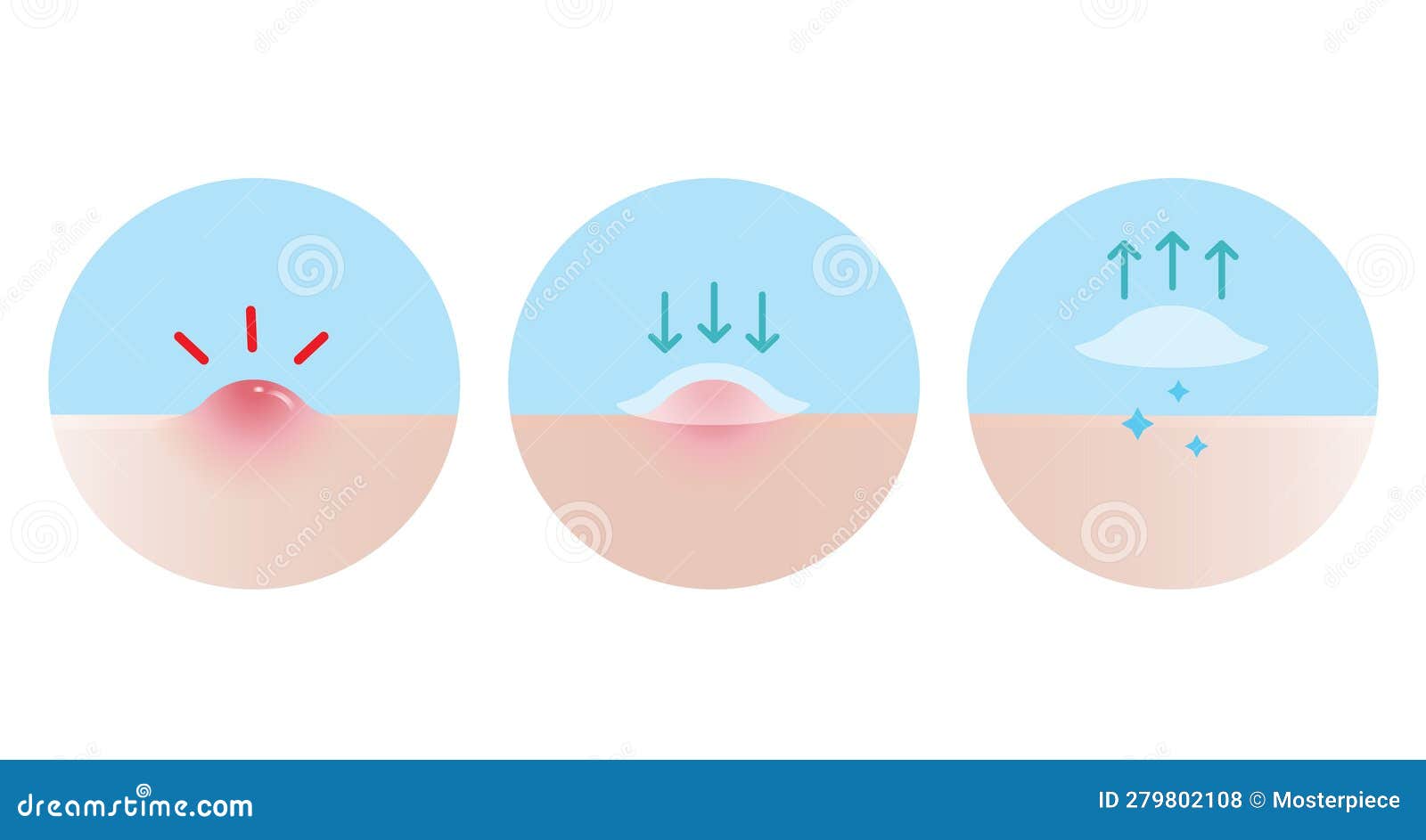 Acne Pimple Treatment For Pustule Vector Illustration On Sky Blue Background Cartoondealer