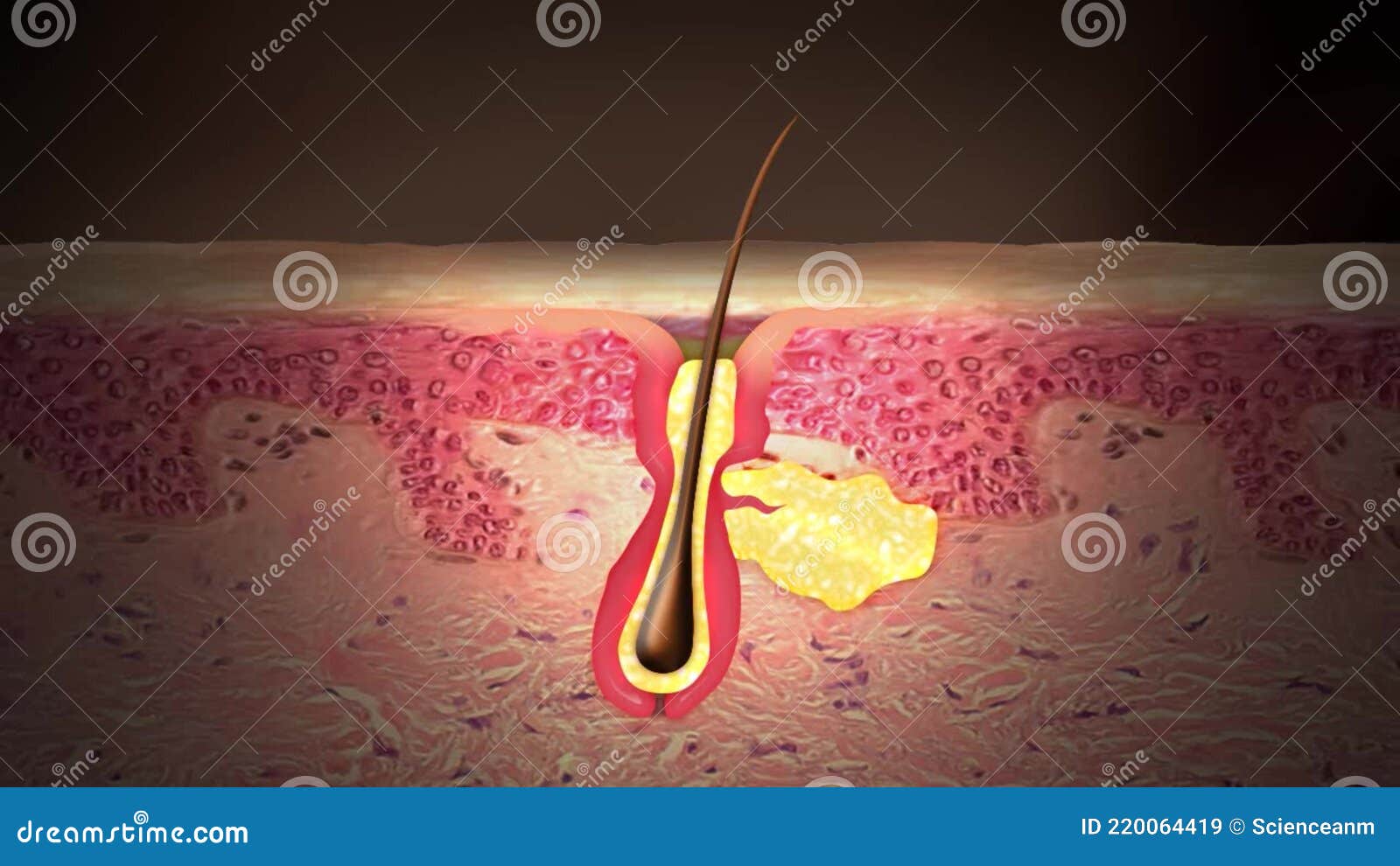 Acne and Pimples, stock illustration. Illustration of people - 220064419