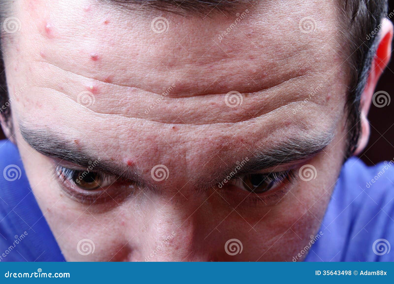 Acne pimples on the face stock photo. Image of appearance - 35643498