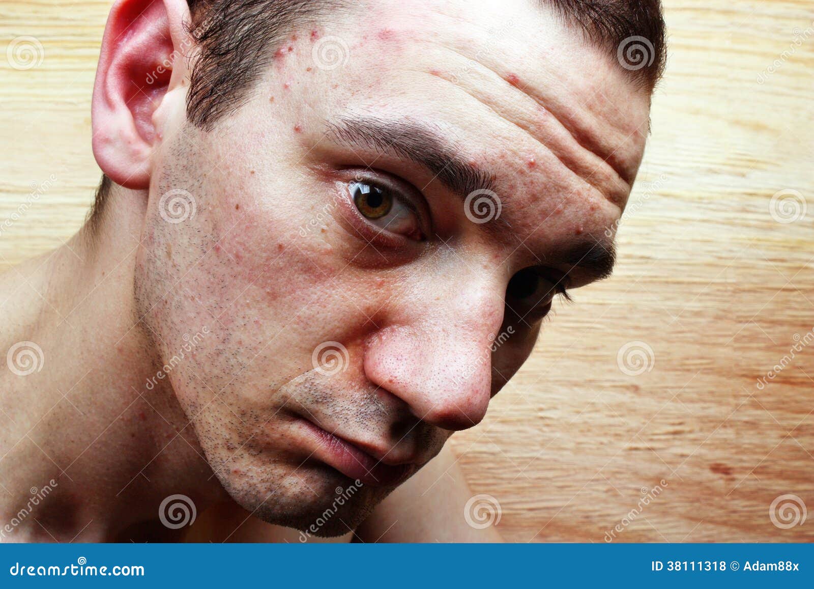 Acne pimples on the face stock photo. Image of face, chronic - 38111318