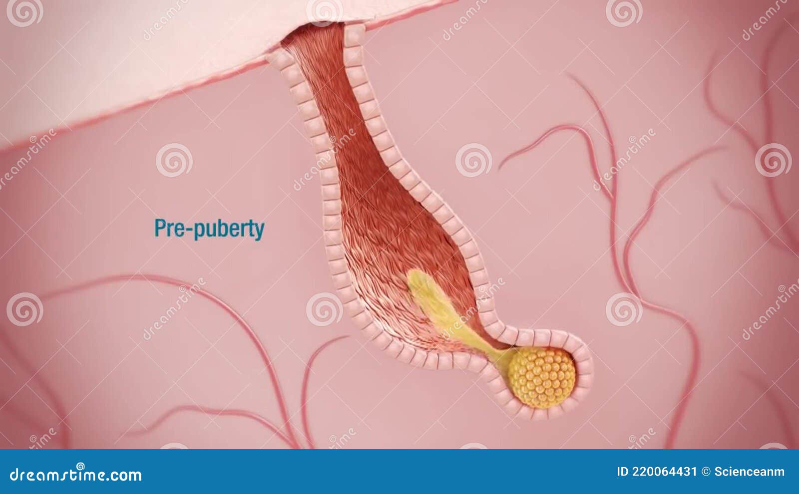 Stages Of Acne Formation In The Human Skin Cartoon Vector ...