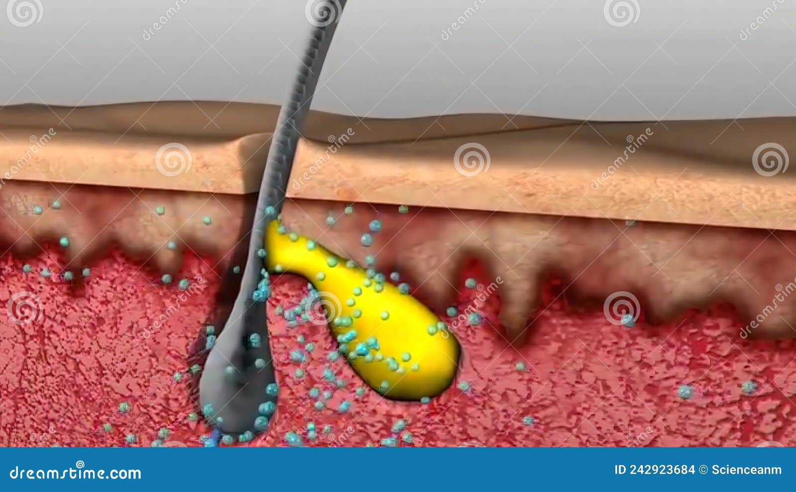Acne and Pimples, Stages of Development Stock Illustration ...