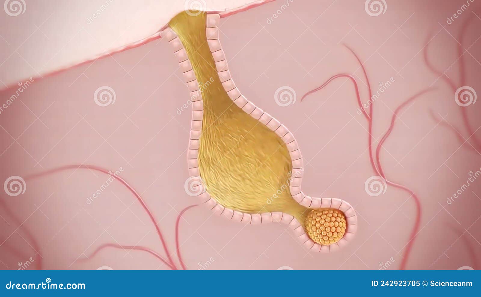 Acne and Pimples, Stages of Development Stock Illustration ...