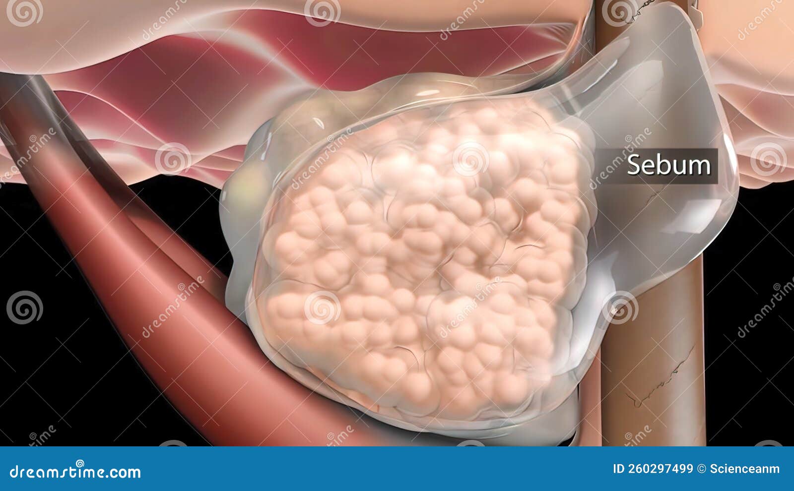 Acne and Pimples, Stages of Development, Graphic Illustration Stock ...