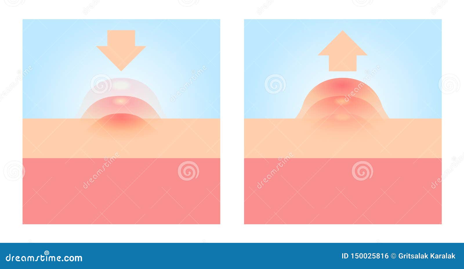 Acne and Pimples, Stages of Development, Vector Icon Stock Vector ...