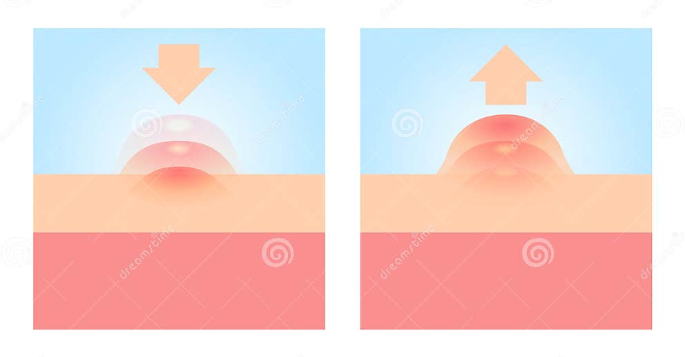 Acne and Pimples, Stages of Development, Vector Icon Stock Vector ...