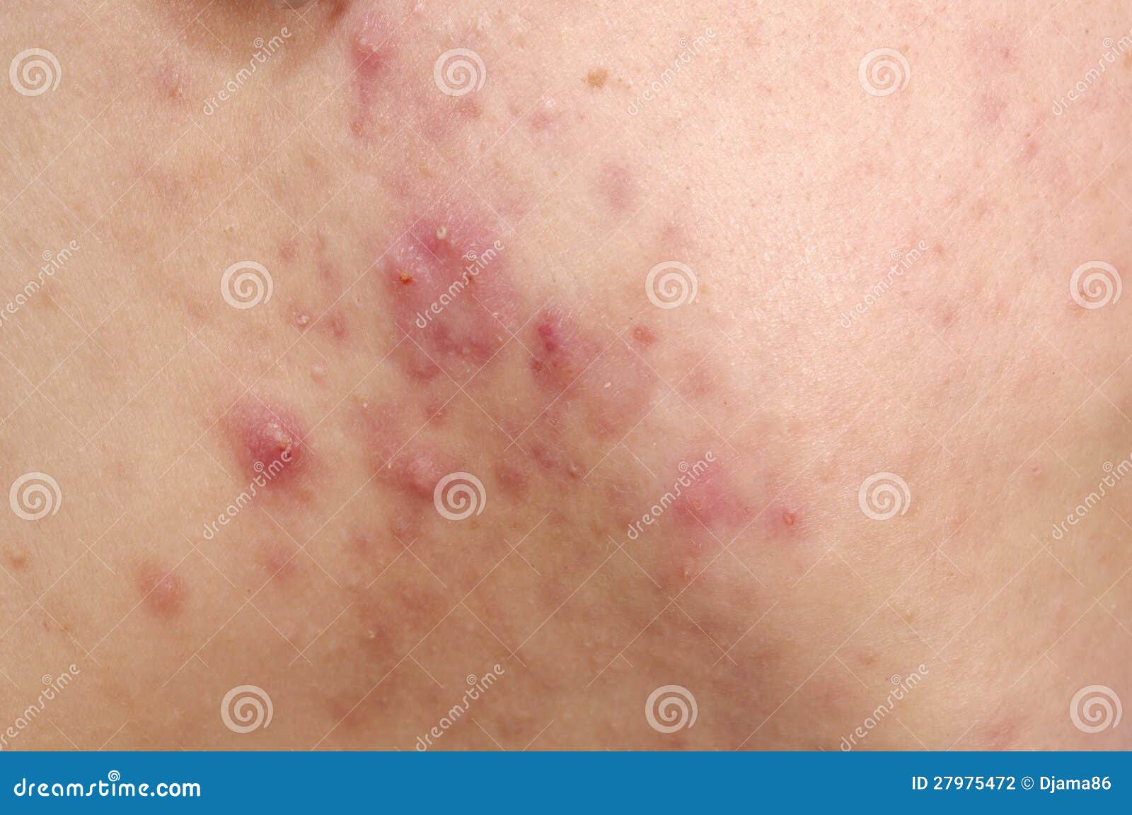 Acne problems stock photo. Image of irritation, female - 27975472