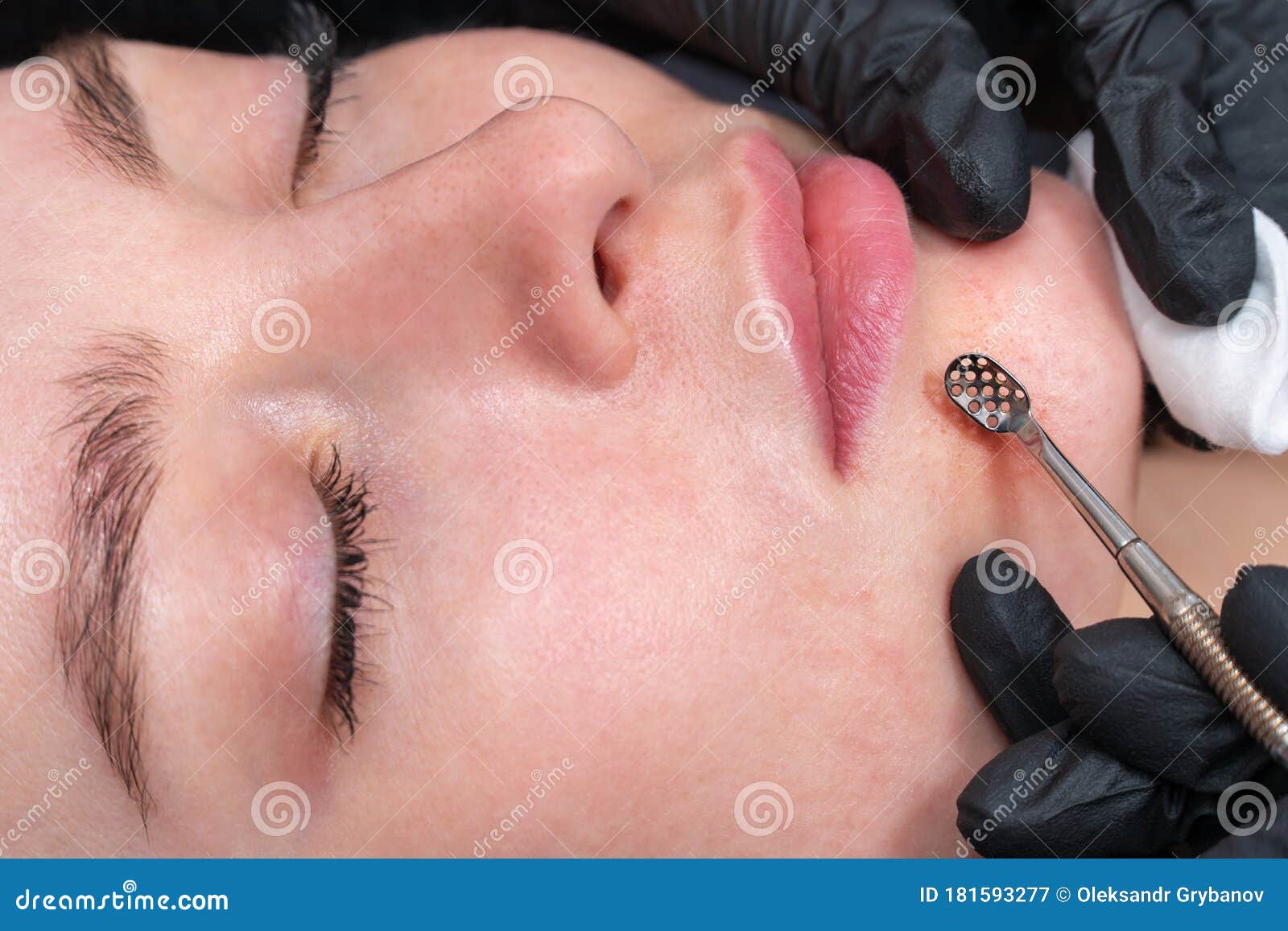 Acne Removal Using an Extractor Stock Image - Image of procedure ...