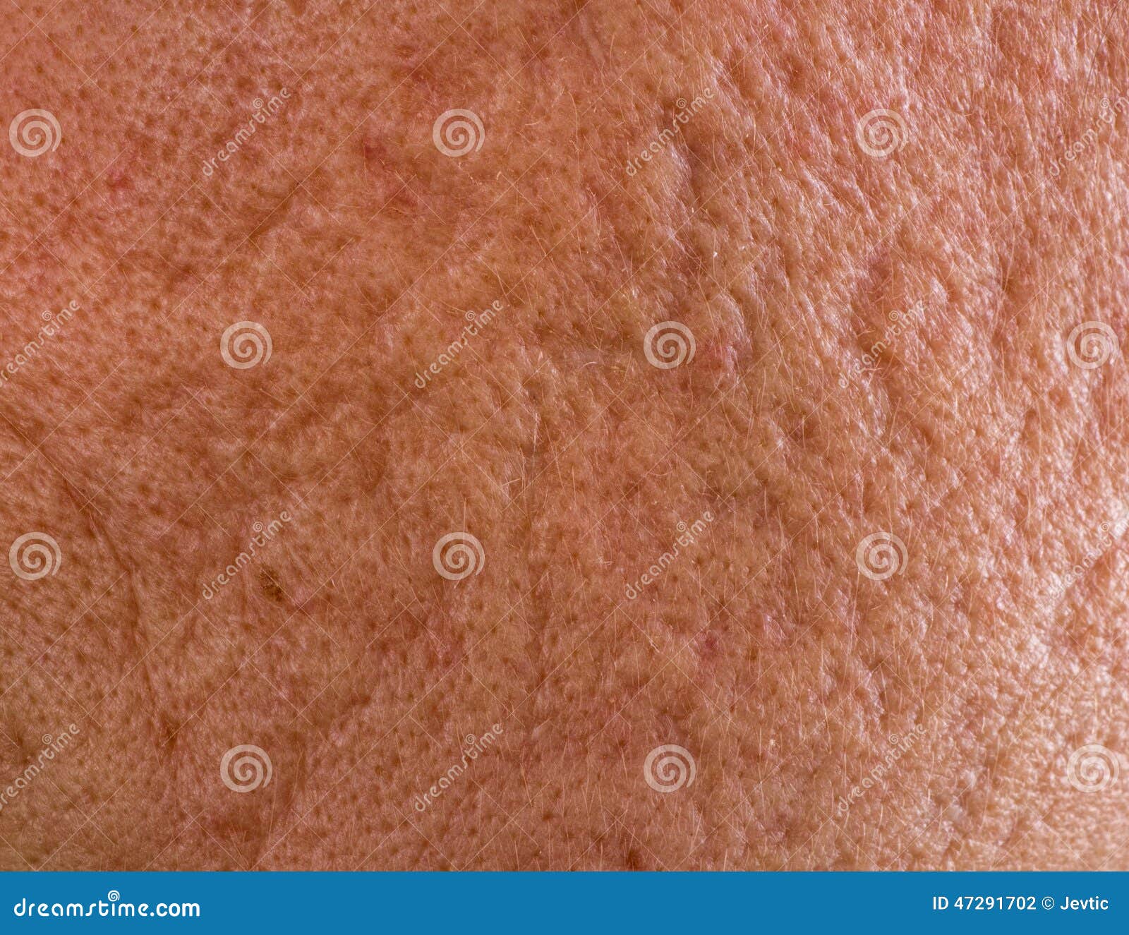 Acne Scars On The Face Royalty-Free Stock Photography | CartoonDealer ...